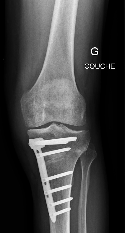 Prothèse de genou et Ostéotomie – Édouard Herriot – Orthopédie Lyon
