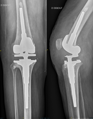 Prothèse de genou et Ostéotomie – Édouard Herriot – Orthopédie Lyon