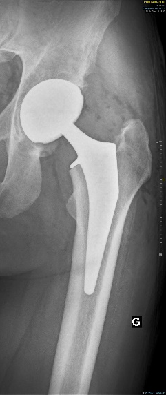 Prothèse totale de hanche – Édouard Herriot – Orthopédie Lyon