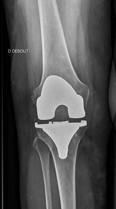 Prothèse de genou et Ostéotomie – Édouard Herriot – Orthopédie Lyon
